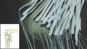 Implantable Medical Textiles | Artificial Ligament | Artificial Skin ...